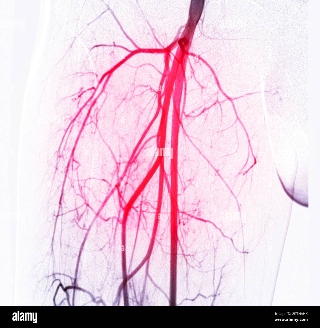 Femoral artery angiogram or angiography Stock Photo - Alamy