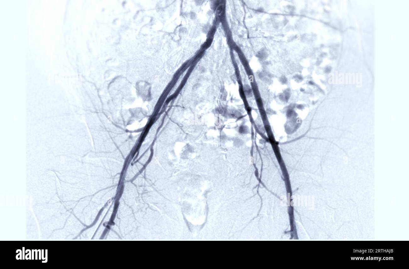 Femoral artery angiogram or angiography Stock Photo - Alamy