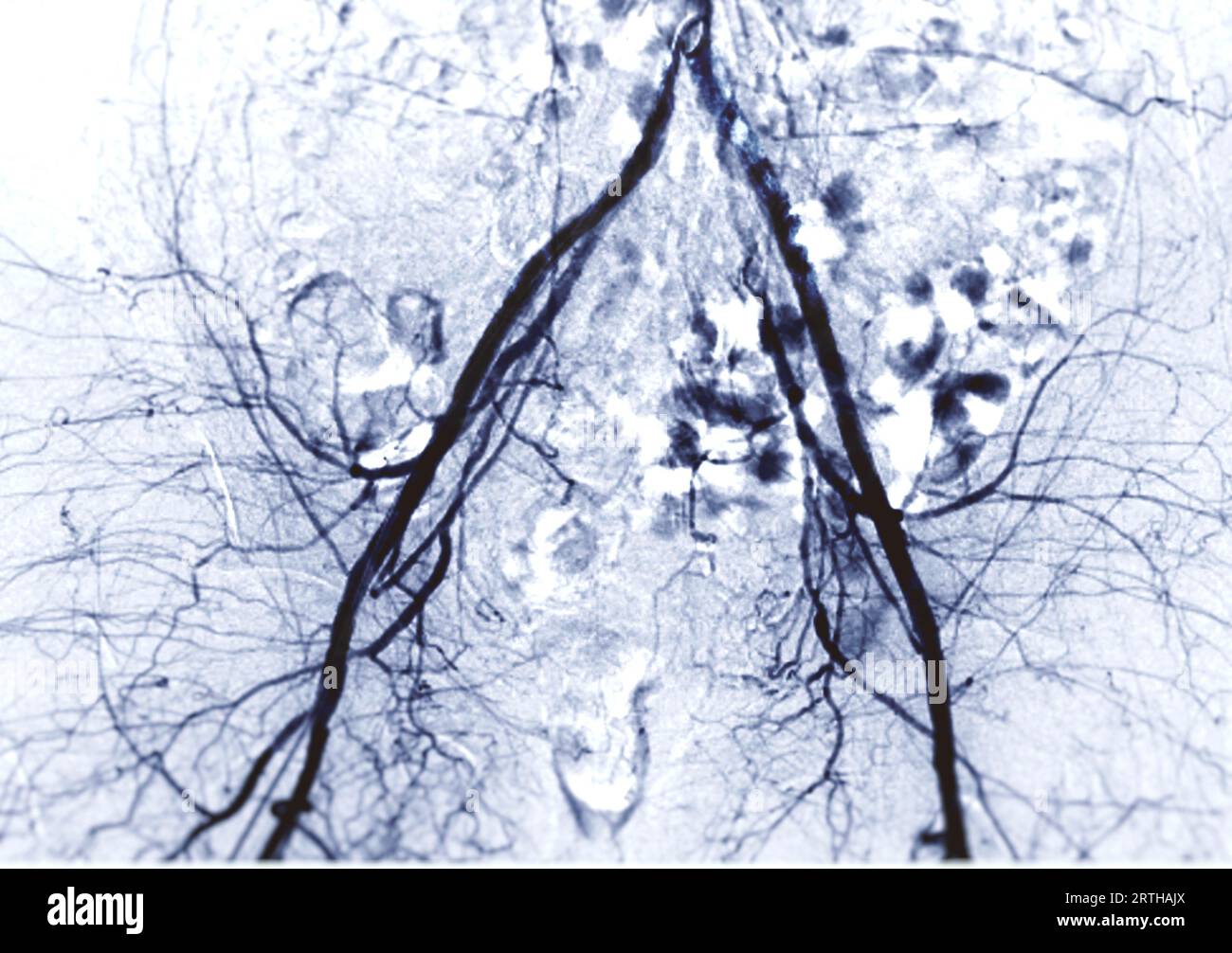 Femoral artery angiogram or angiography Stock Photo - Alamy
