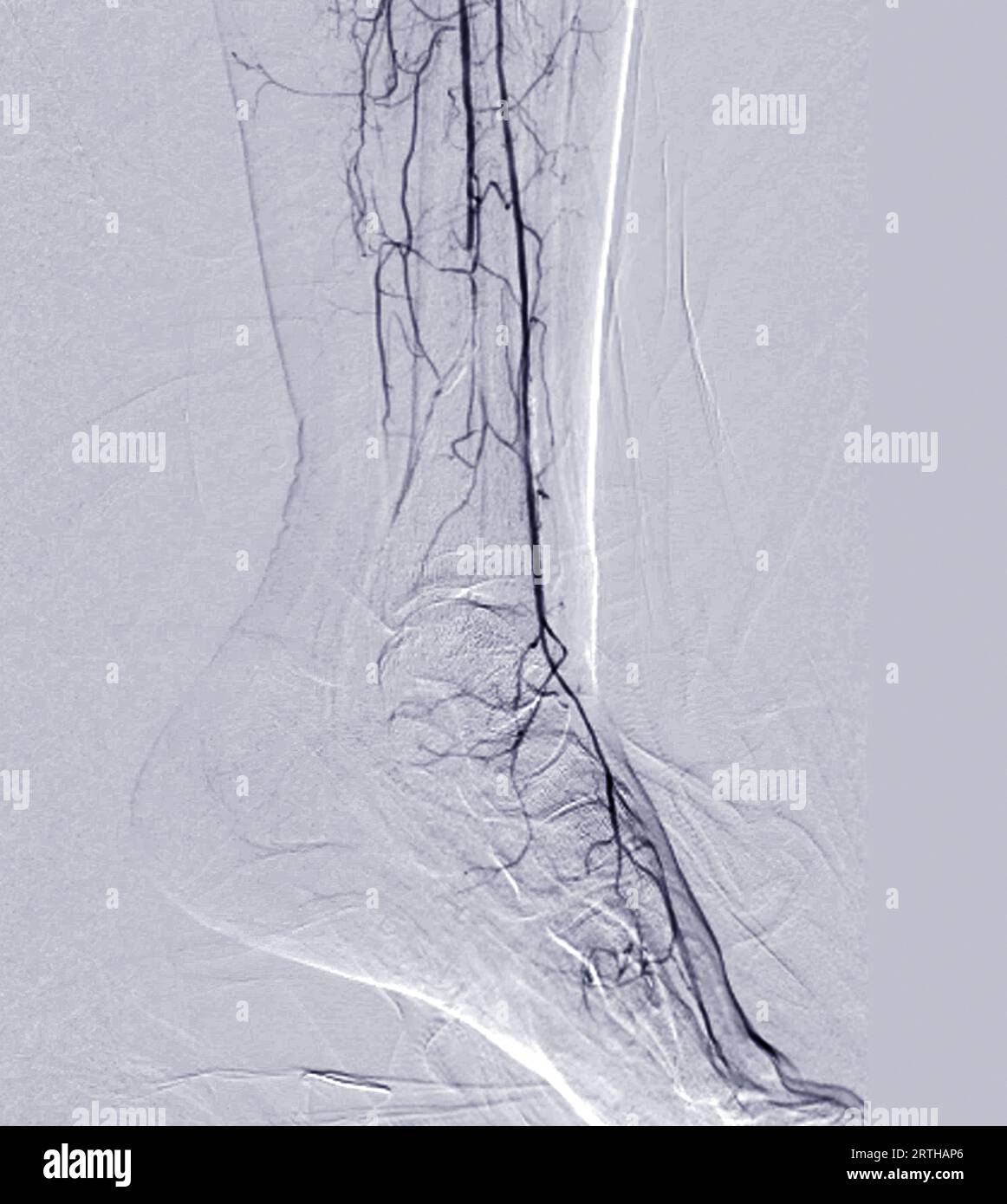 Foot angiorgam or Plantar angiogram angiogram showing Plantar and ...