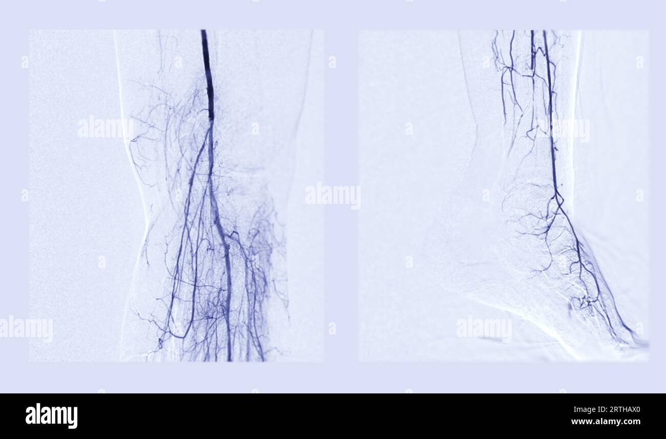 Foot angiorgam or Plantar angiogram angiogram showing Plantar and ...