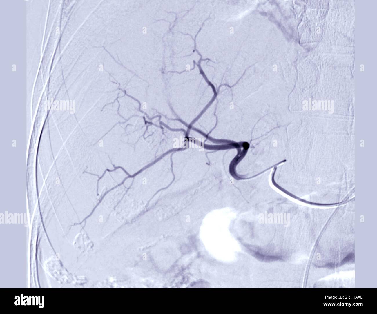 Imaging of TACE or Chemoembolization is a procedure that allows a dose ...