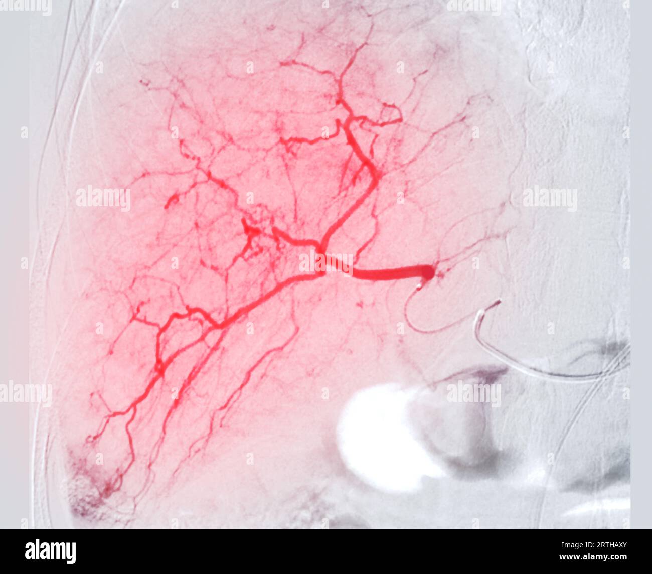 Imaging of TACE or Chemoembolization is a procedure that allows a dose ...
