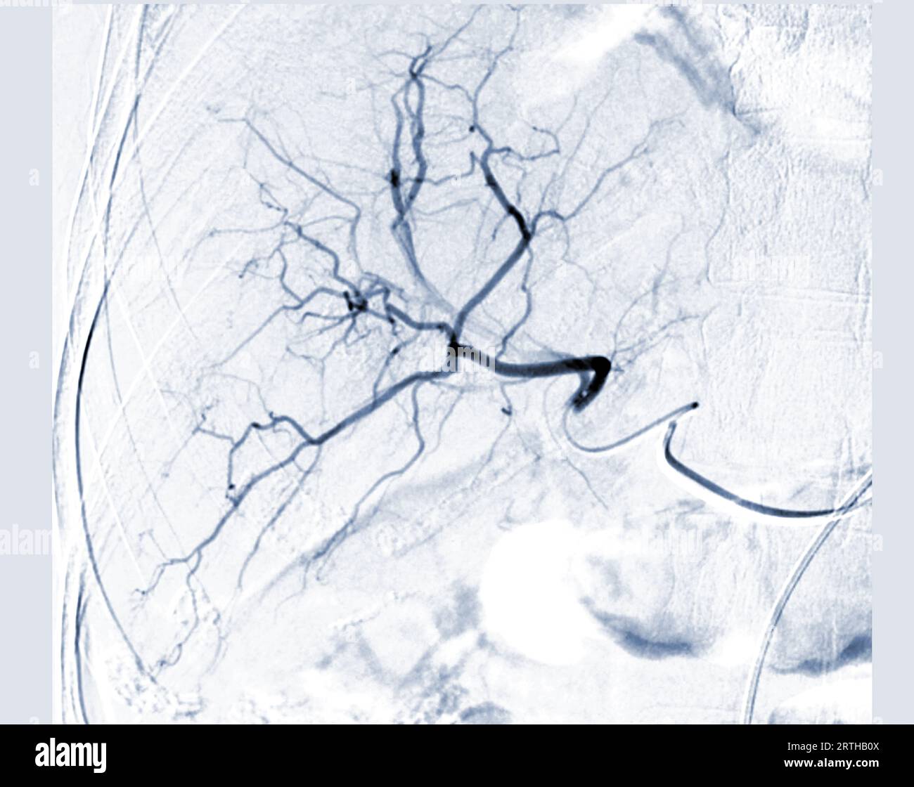 Imaging of TACE or Chemoembolization is a procedure that allows a dose ...