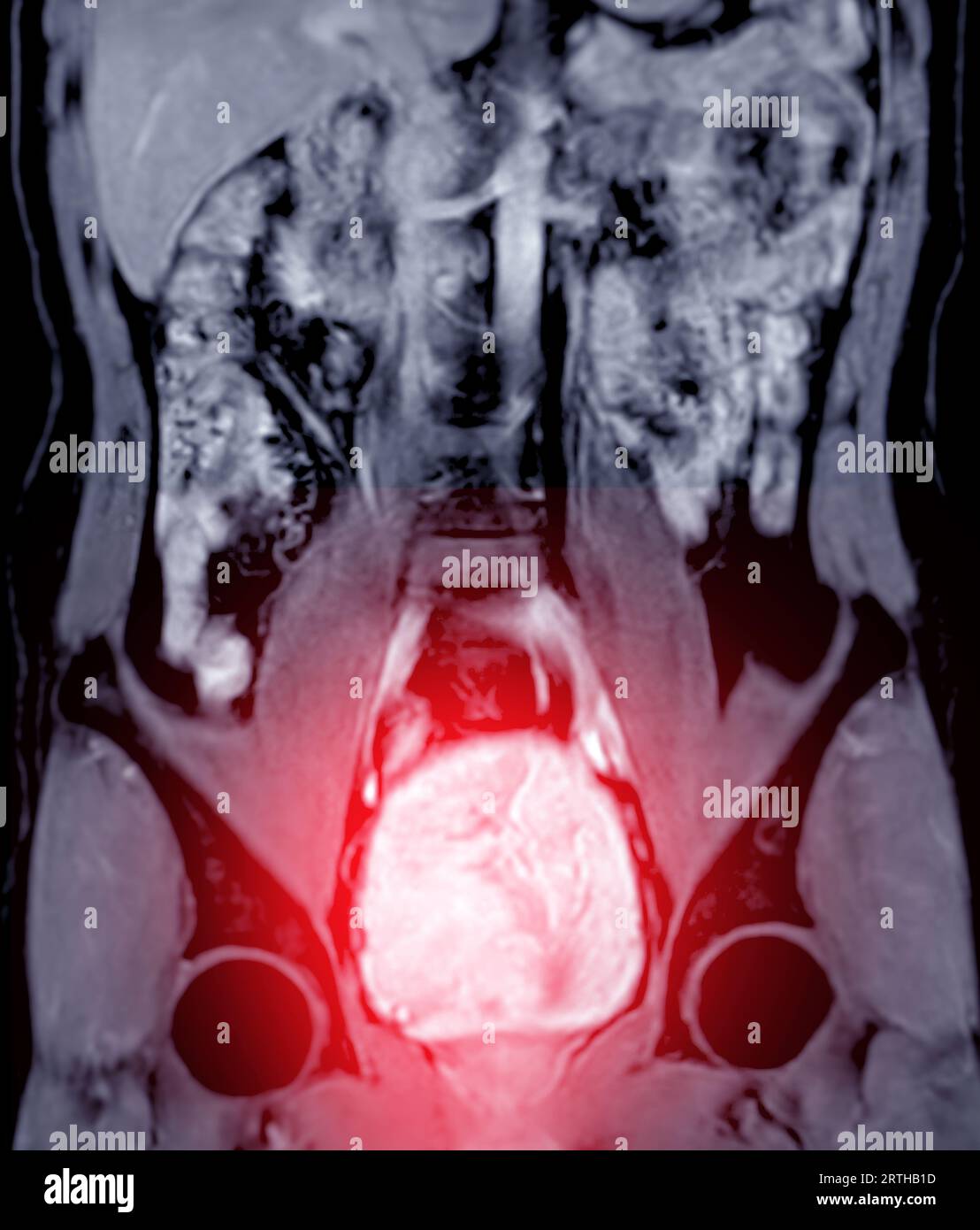 Magnetic resonance urography (MR urography) is a MRI study that ...