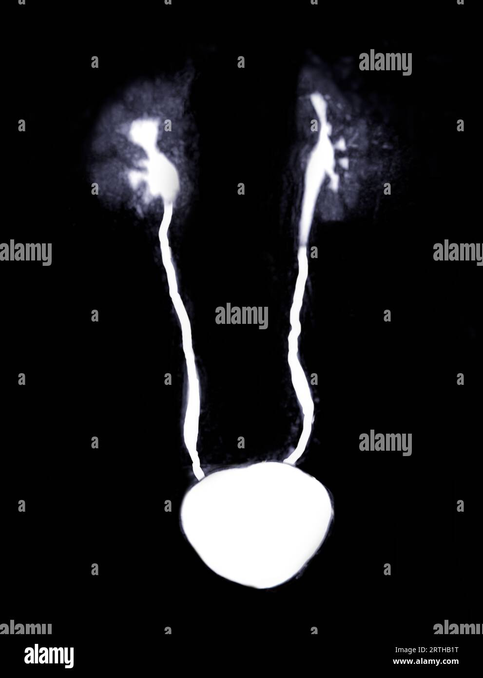 Magnetic resonance urography (MR urography) is a MRI study that ...