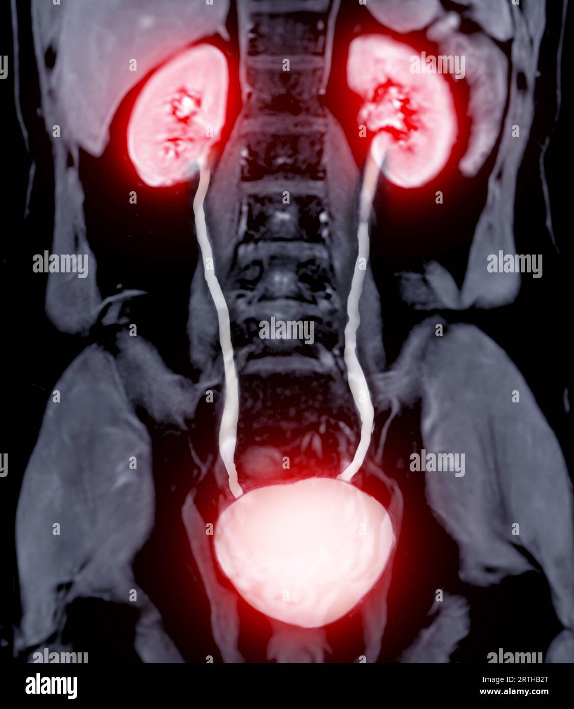 Magnetic resonance urography (MR urography) is a MRI study that ...