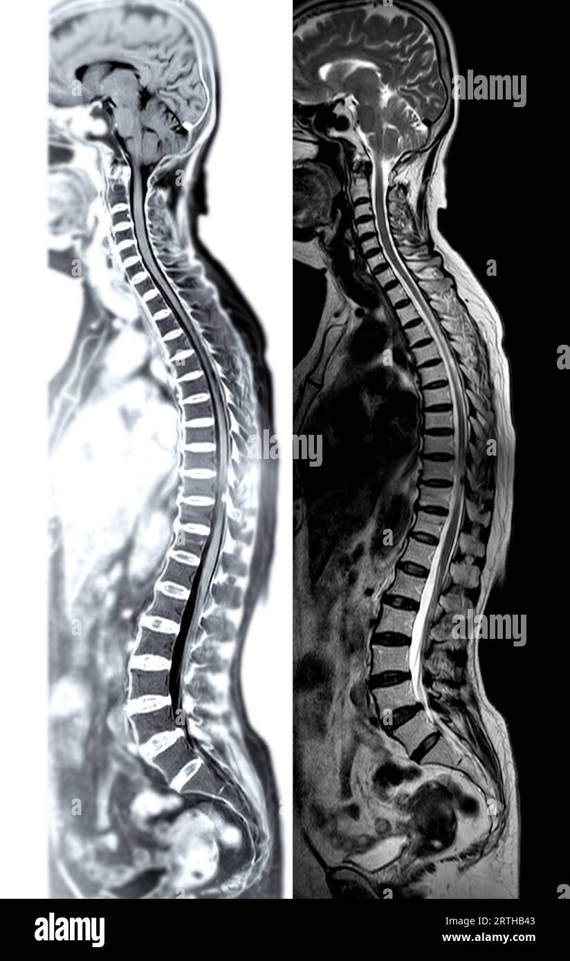 MRI whole spine screening for diagnosis spinal cord compression Stock ...