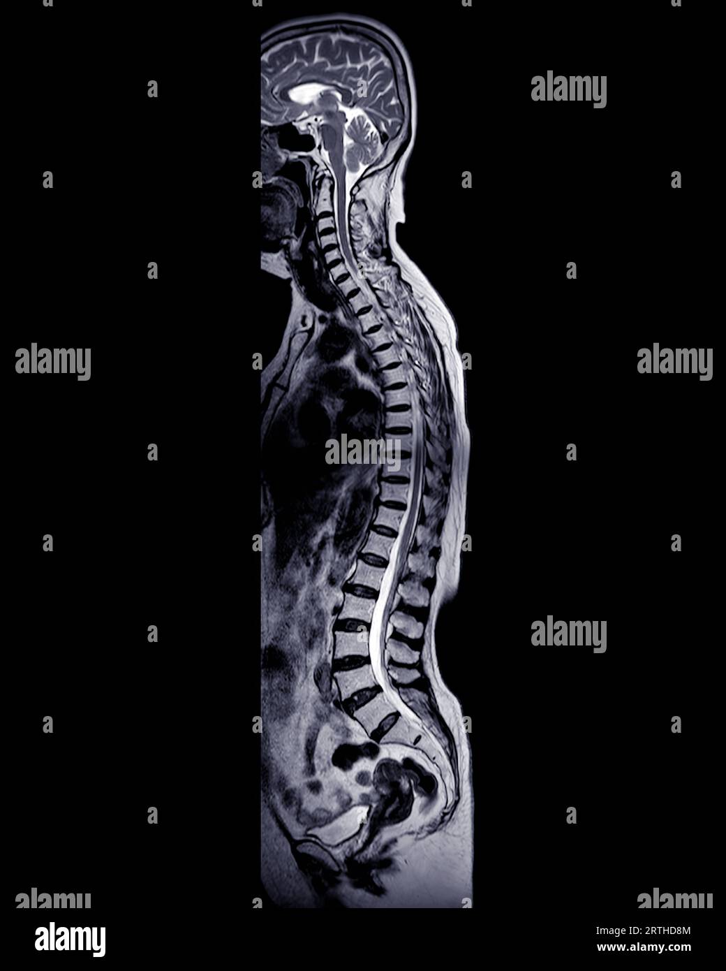 MRI whole spine screening for diagnosis spinal cord compression Stock Photo - Alamy