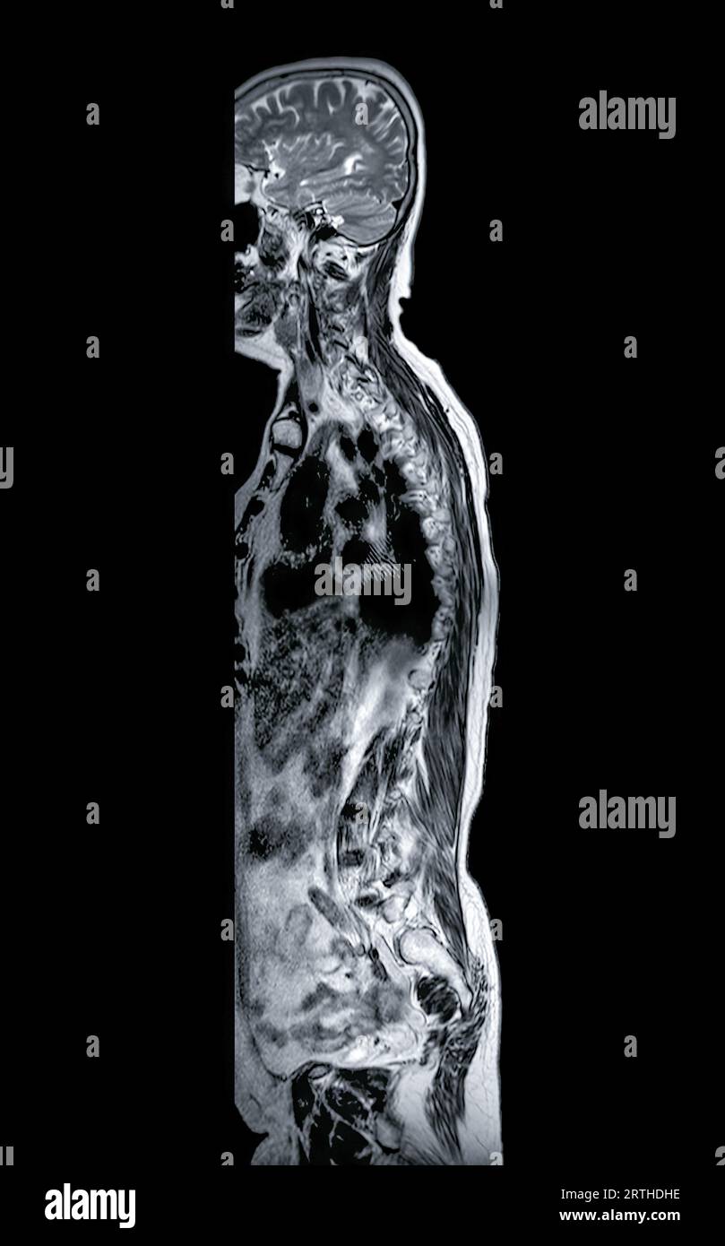 MRI whole spine screening for diagnosis spinal cord compression Stock Photo - Alamy