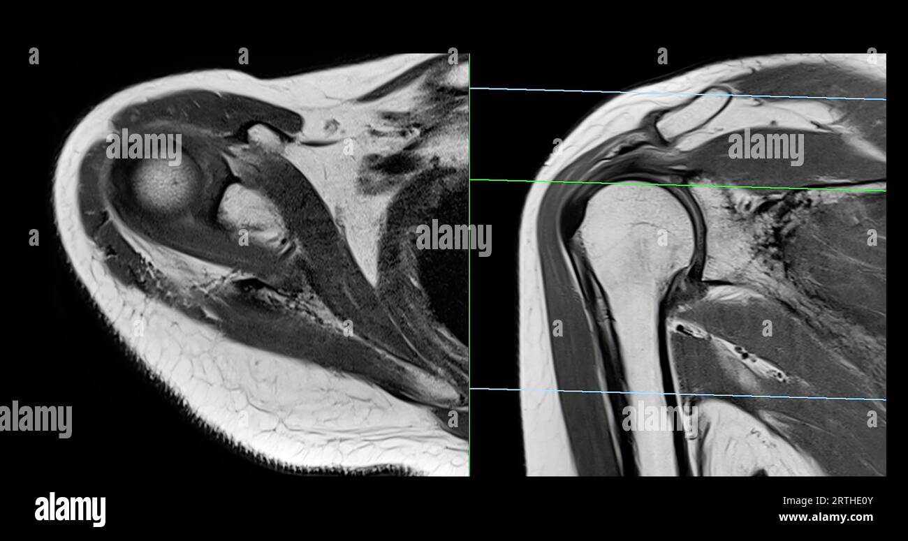 Radiology Mri Shoulder