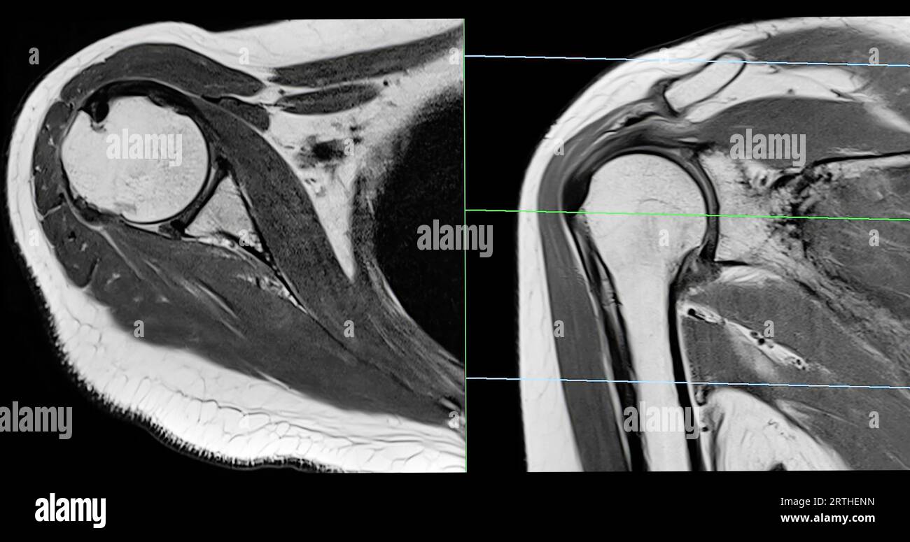 Magnetic Resonance Imaging or MRI of Shoulder Joint for diagnostic ...