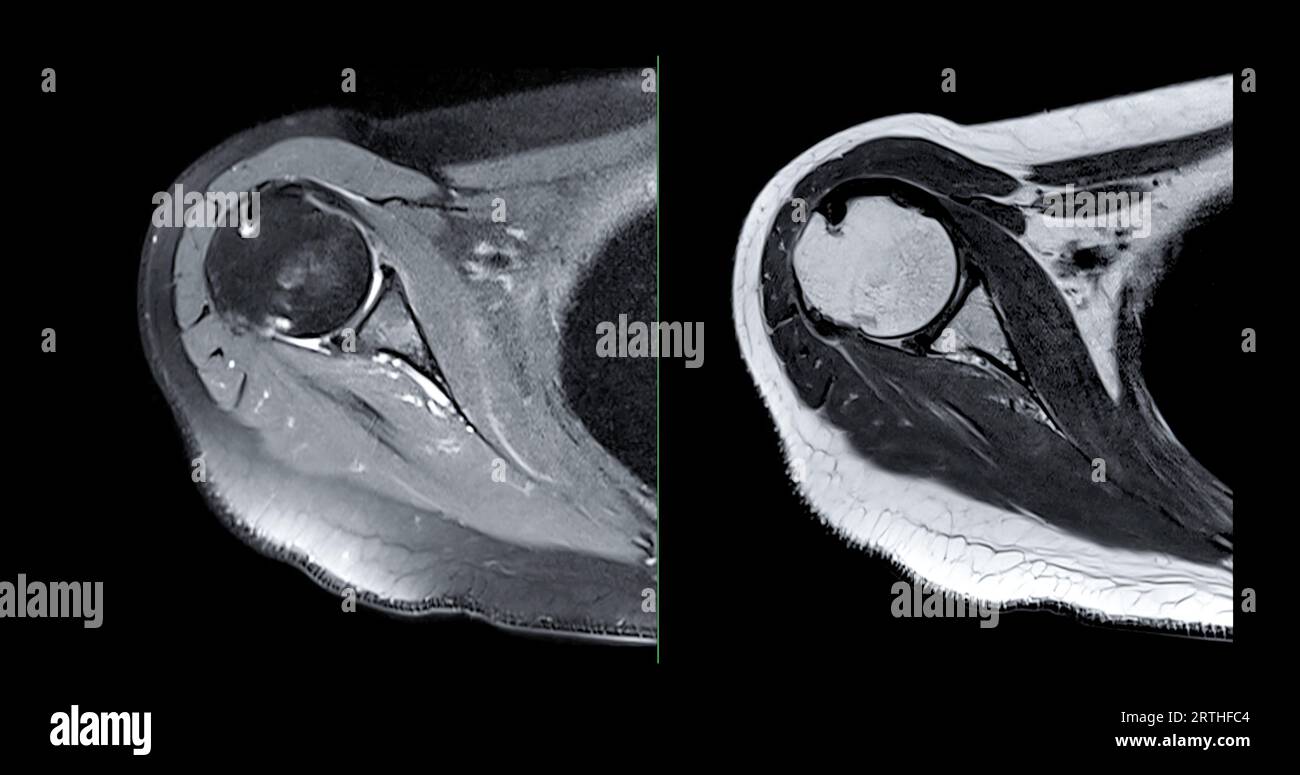 Magnetic Resonance Imaging or MRI of Shoulder Joint for diagnostic ...