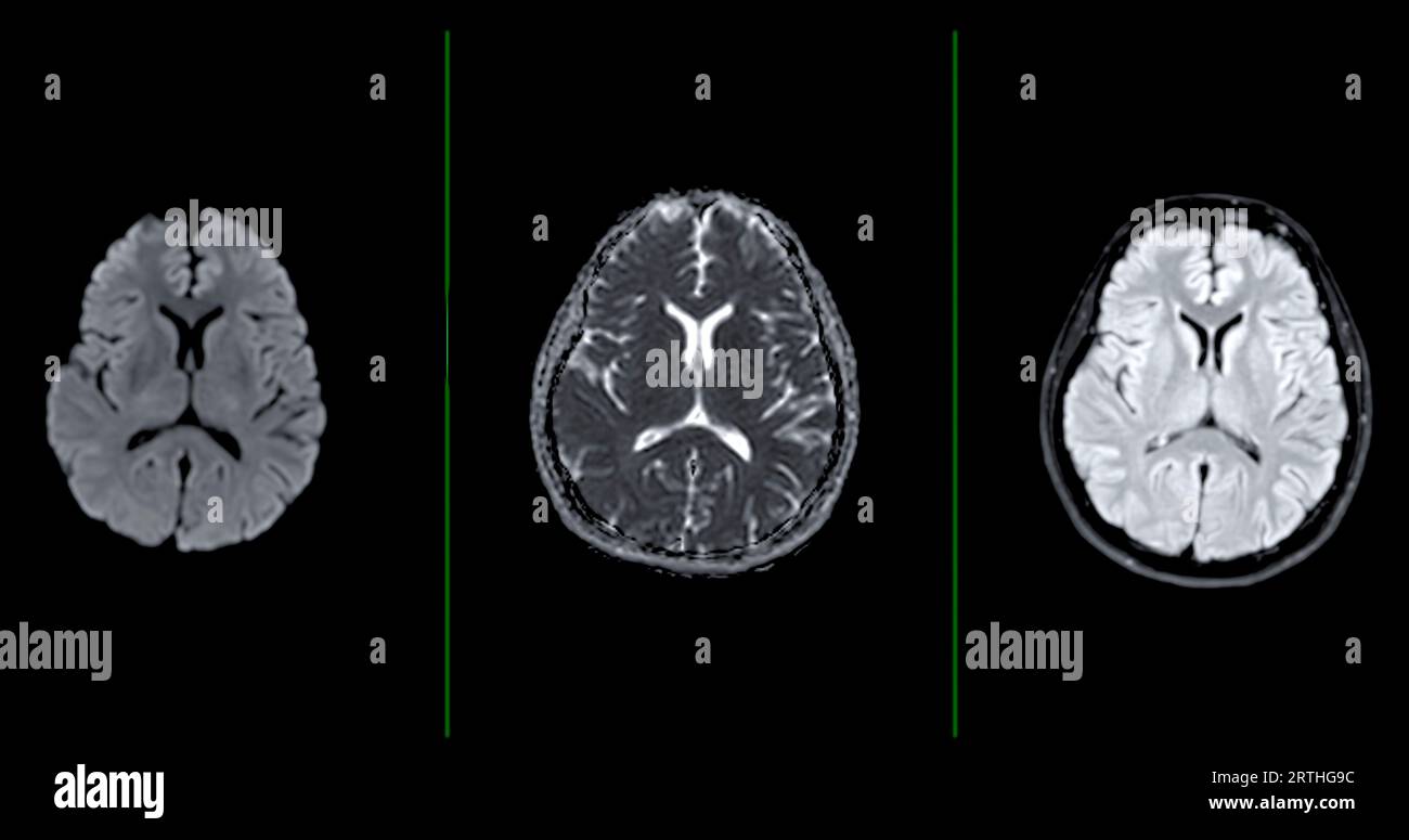 Mri Brain Scan Axial Diffusion Technique For Detect Brain Diseases Sush