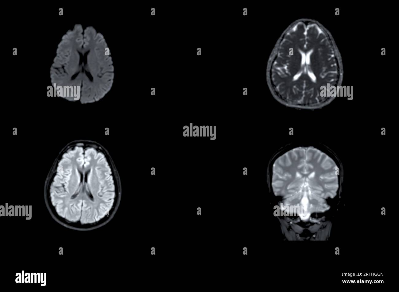 MRI brain scan axial Diffusion technique and coronal gredient for detect Brain diseases sush as ...