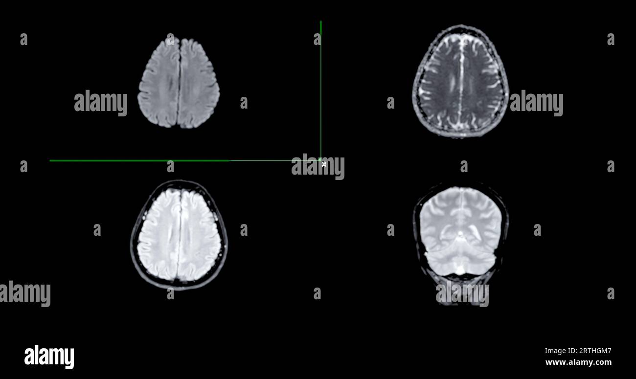 MRI brain scan axial Diffusion technique and coronal gredient for ...