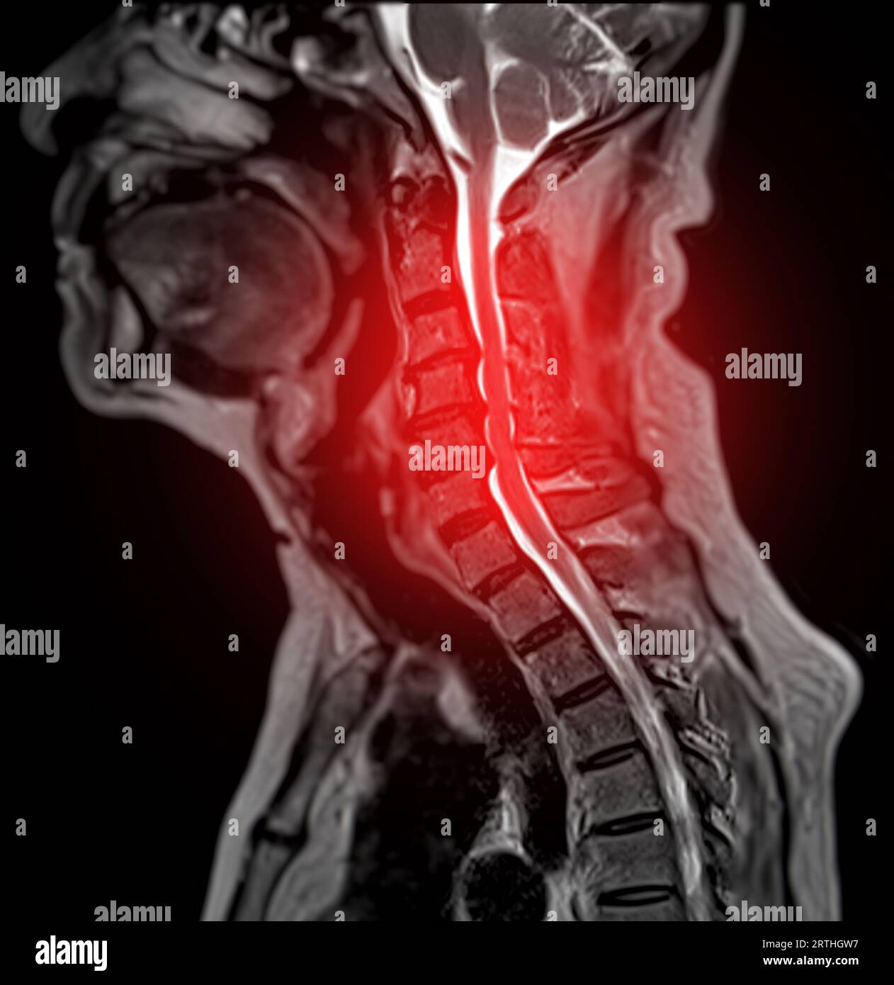 Mri Of C Spine Or Magnetic Resonance Image Of Cervical Spine Sagittal T2 Fs View For Diagnosis