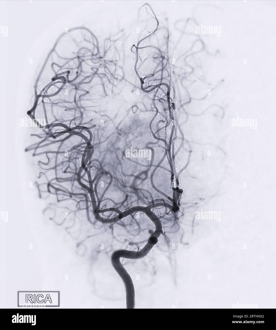 Cerebral angiography image from Fluoroscopy in intervention radiology ...