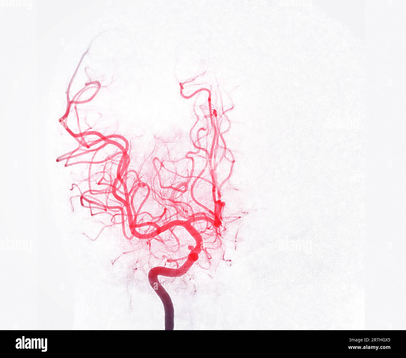 Cerebral angiography image from Fluoroscopy in intervention radiology ...