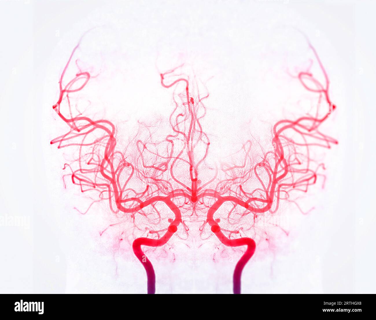 Cerebral angiography image from Fluoroscopy in intervention radiology ...