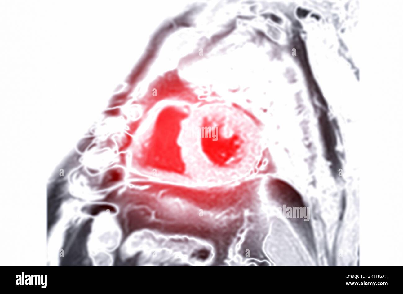 Mri Heart Or Cardiac Mri Magnetic Resonance Imaging Of Heart Short Axis View For Diagnosis