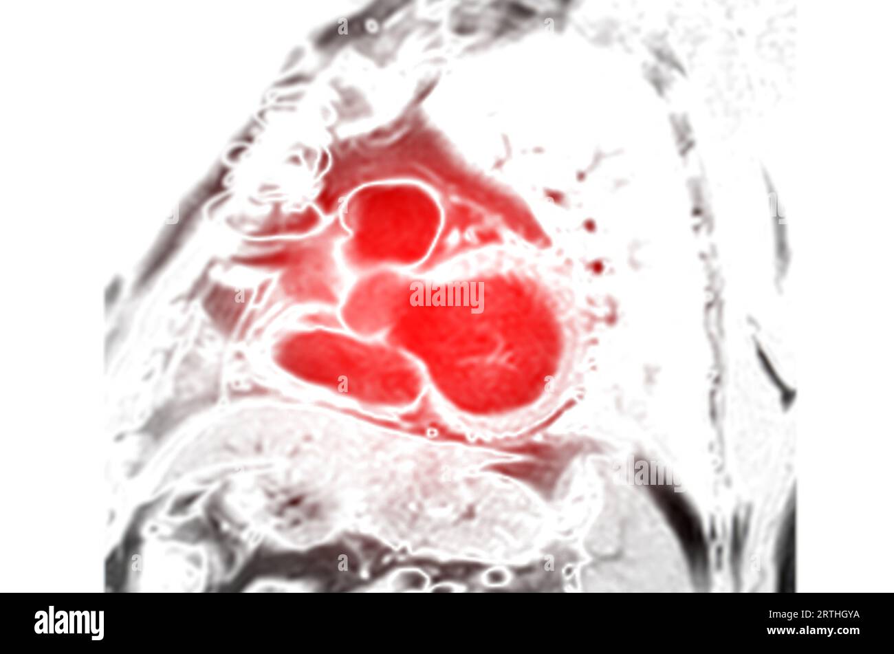 MRI heart or Cardiac MRI ( magnetic resonance imaging ) of heart Short ...