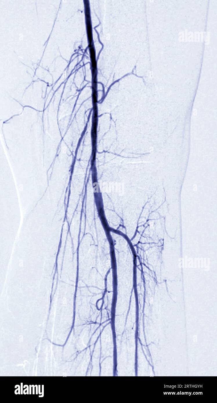 Femoral artery angiogram or angiography at knee area Stock Photo - Alamy