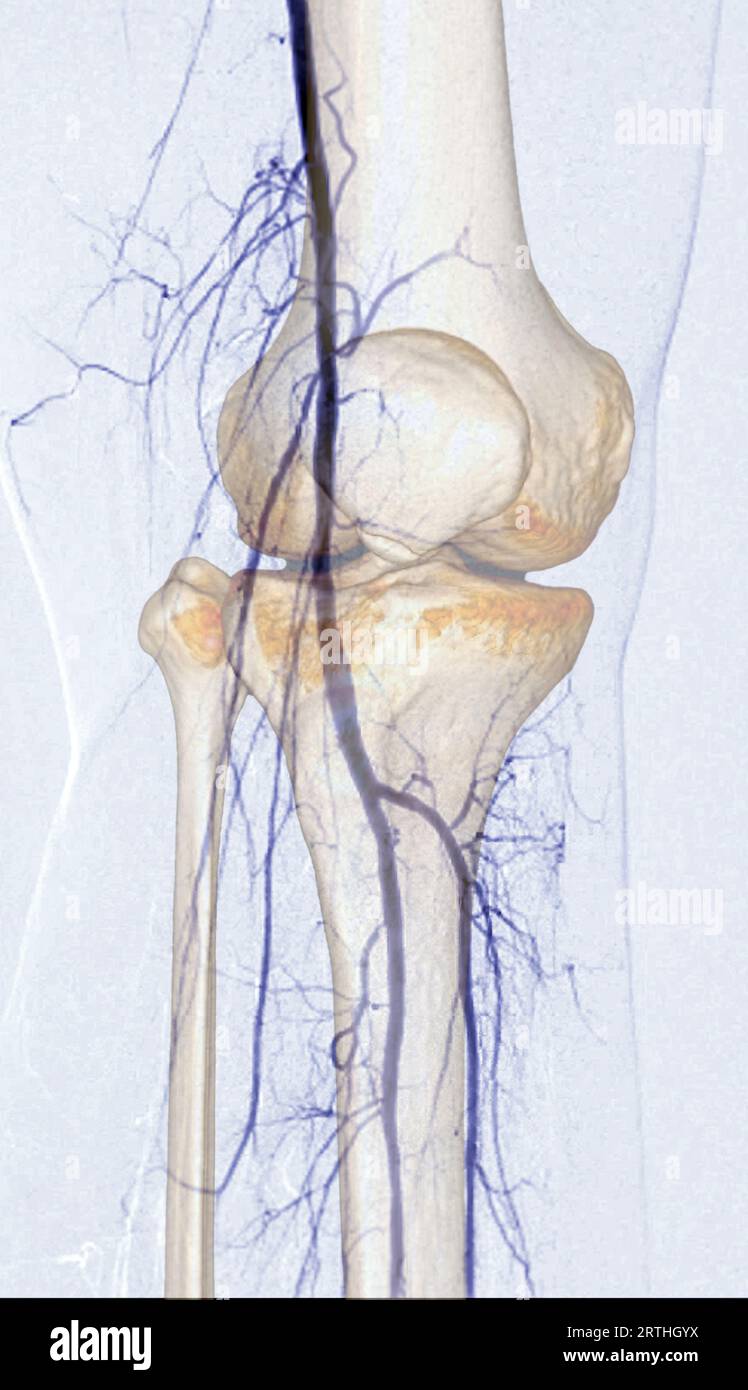 Femoral artery angiogram or angiography at knee area Stock Photo - Alamy