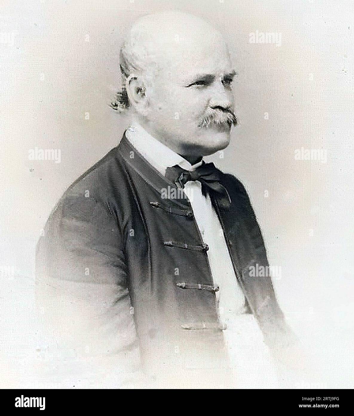 IGNAZ SEMMELWEIS (1818-1865) Hungarian physician and pioneer of ...