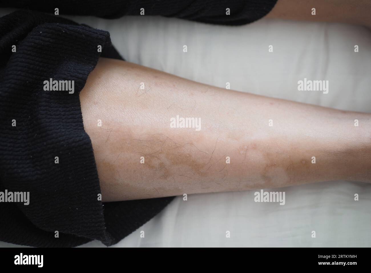 feet with vitiligo skin condition Stock Photo - Alamy