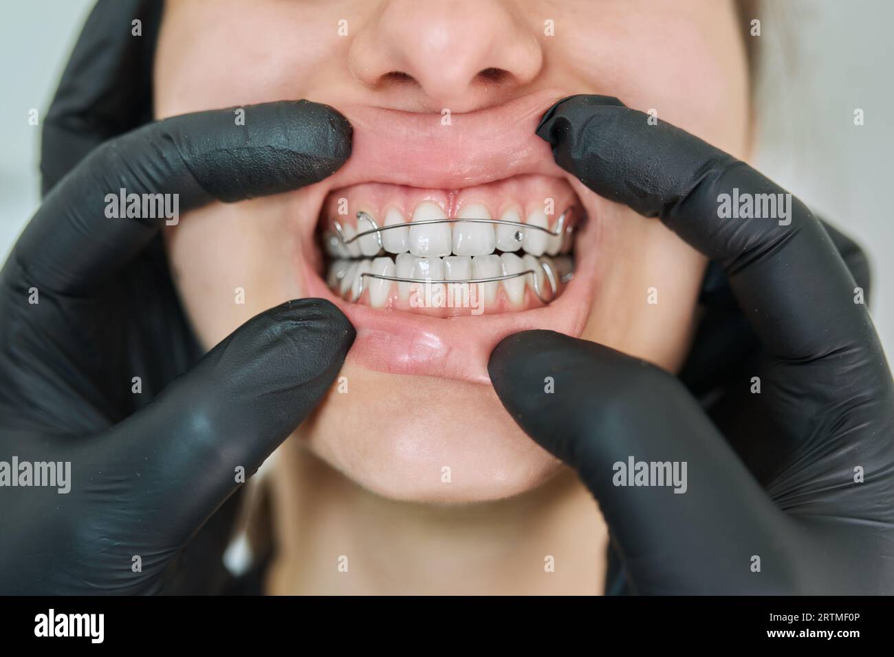 Close-up of open mouth with teeth with metal orthodontic plate Stock ...