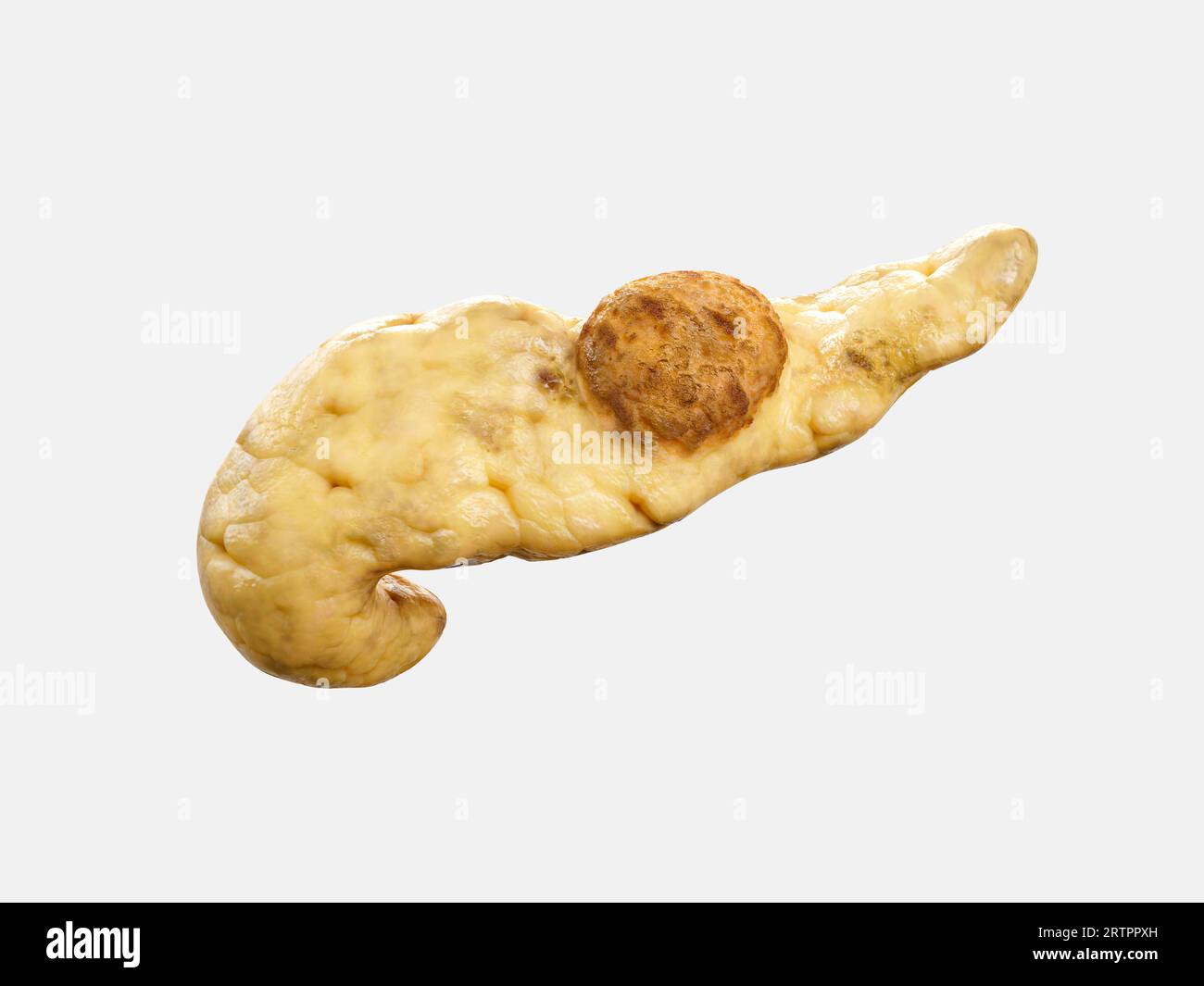Cancer of human pancreas isolated on white. Tumor of pancreas. 3d ...