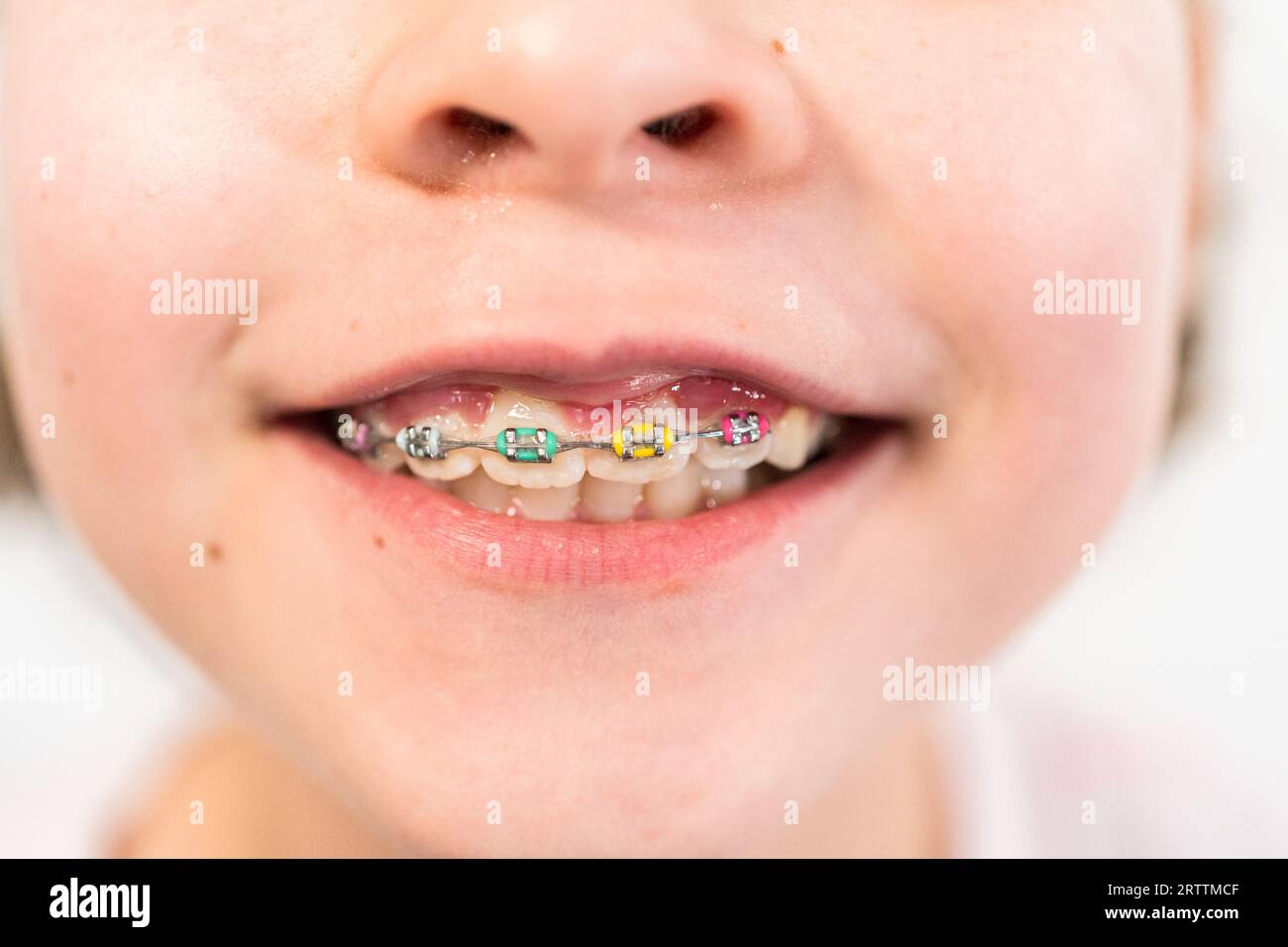 Little girl with rainbow braces Stock Photo - Alamy