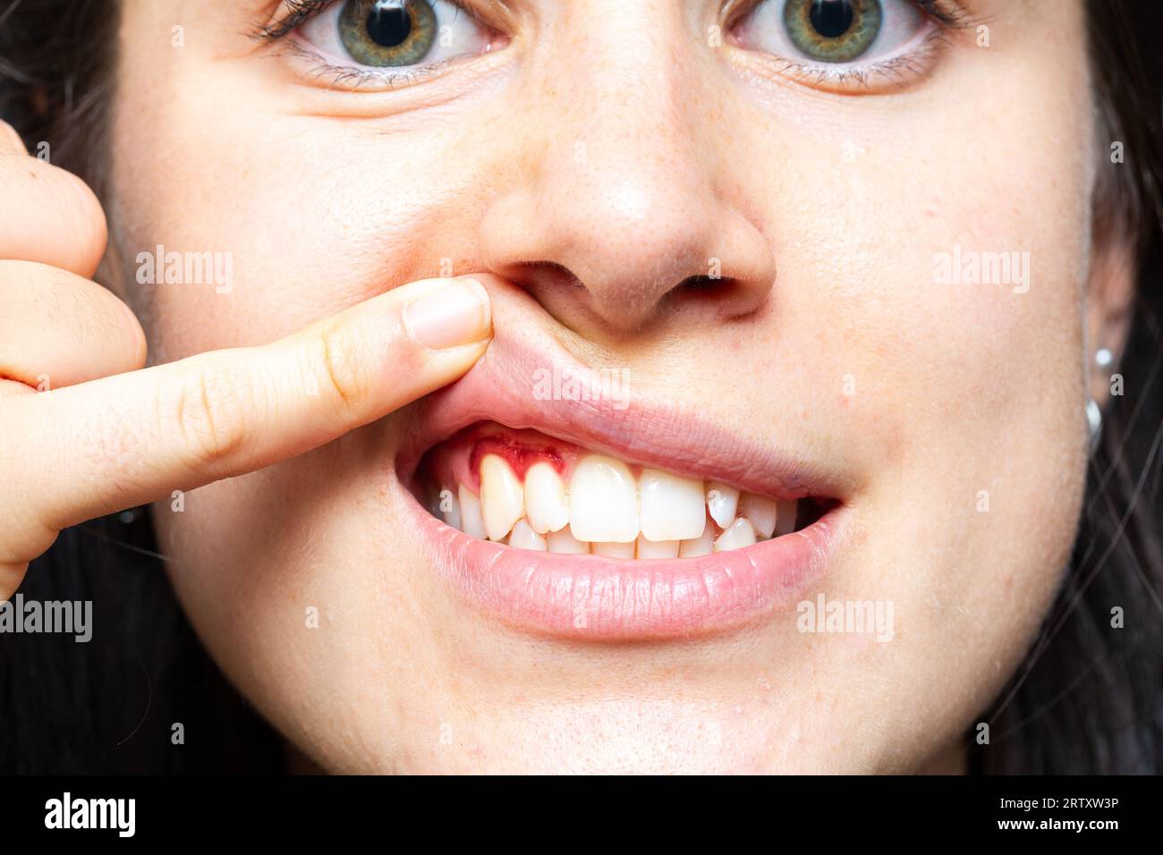 Gingivitis hi-res stock photography and images - Alamy
