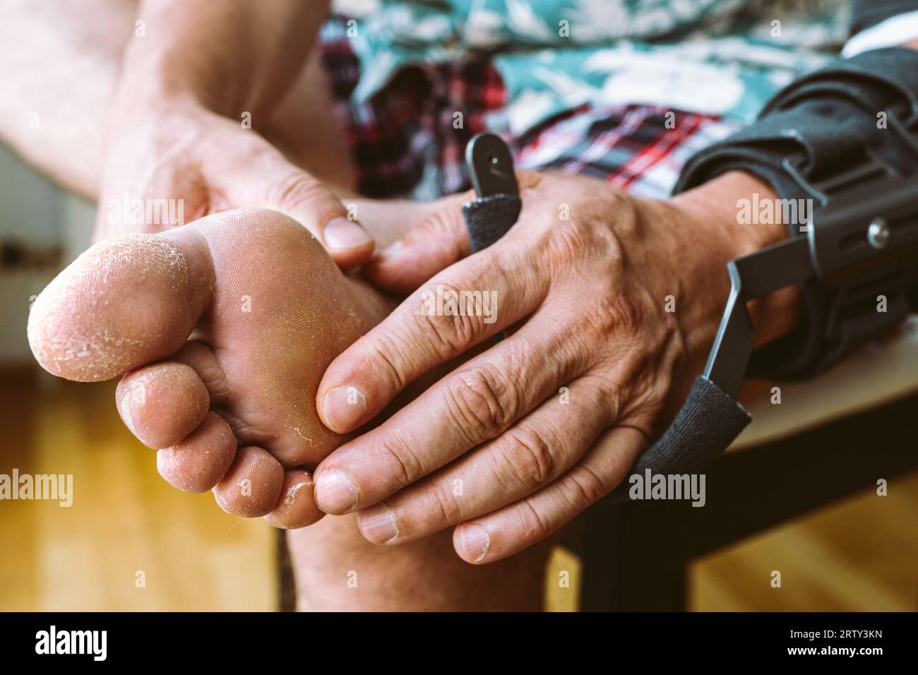 man scratches and scratches dry, cracked skin feet Stock Photo - Alamy
