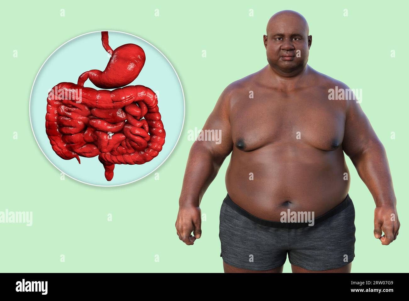 Obese man's digestive system, illustration Stock Photo - Alamy