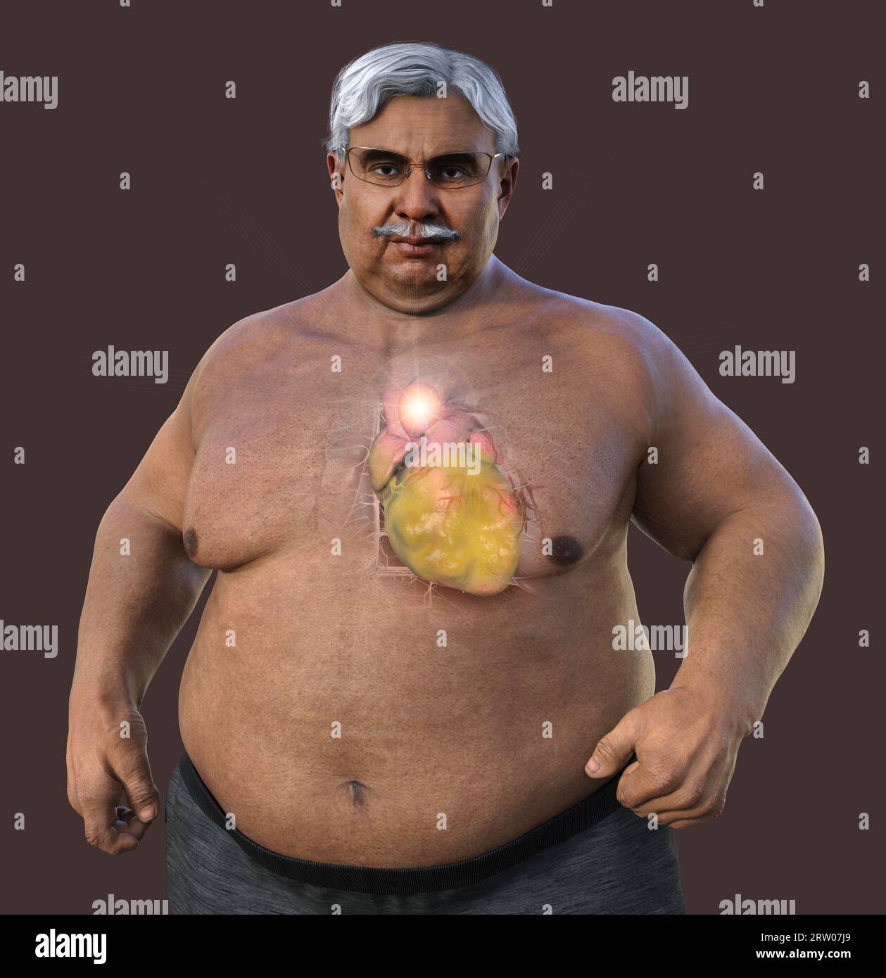 Obese man with ascending aortic aneurysm, illustration Stock Photo - Alamy Obese man with ascending aortic aneurysm, illustration Stock Photo - Alamy