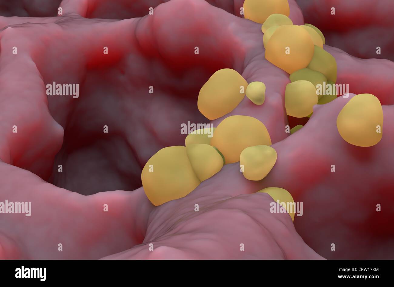 Small cancer tumors on the lung tissue: lung cancer (LC) - closeup view ...