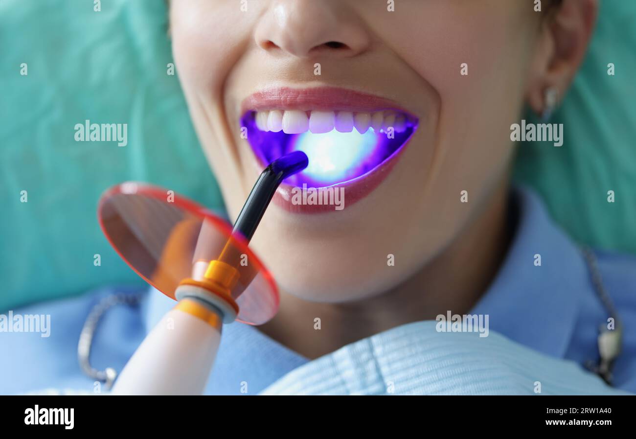 Dentist doctor fills patient teeth with curing light closeup Stock ...