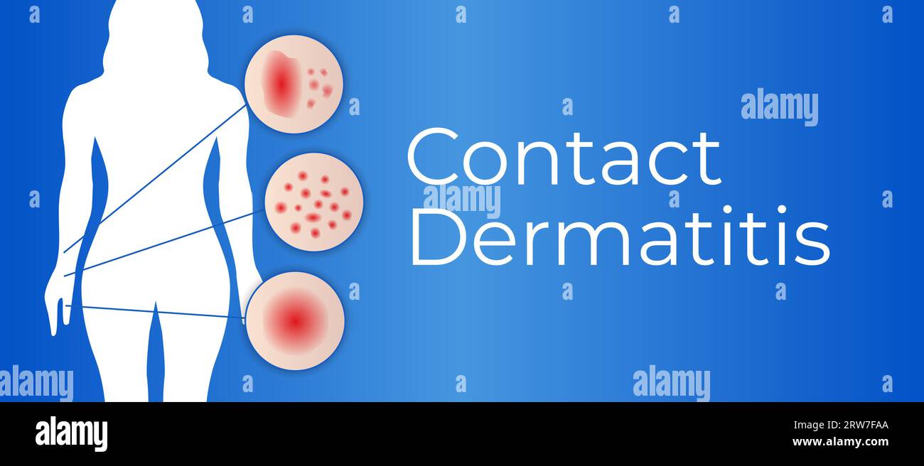 Contact dermatitis hi-res stock photography and images - Alamy