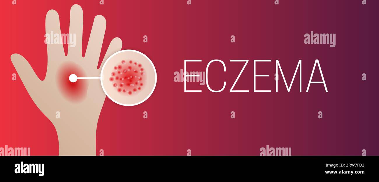 Red Hand Eczema Background Illustration Design Stock Vector Image & Art ...