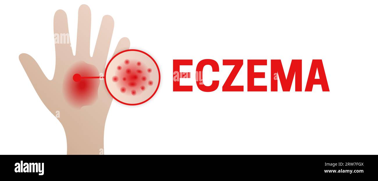 Itchy psoriasis illness background Stock Vector Images - Alamy