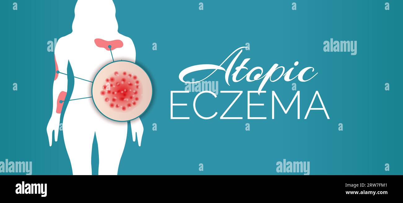 Atopic Eczema Background Illustration Banner With Woman Stock Vector