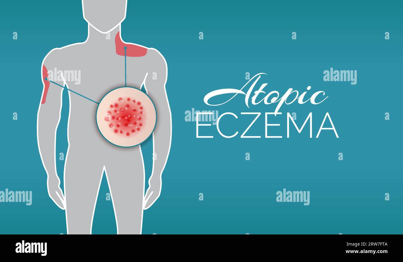 Atopic Eczema Background Illustration Banner With Man Stock Vector