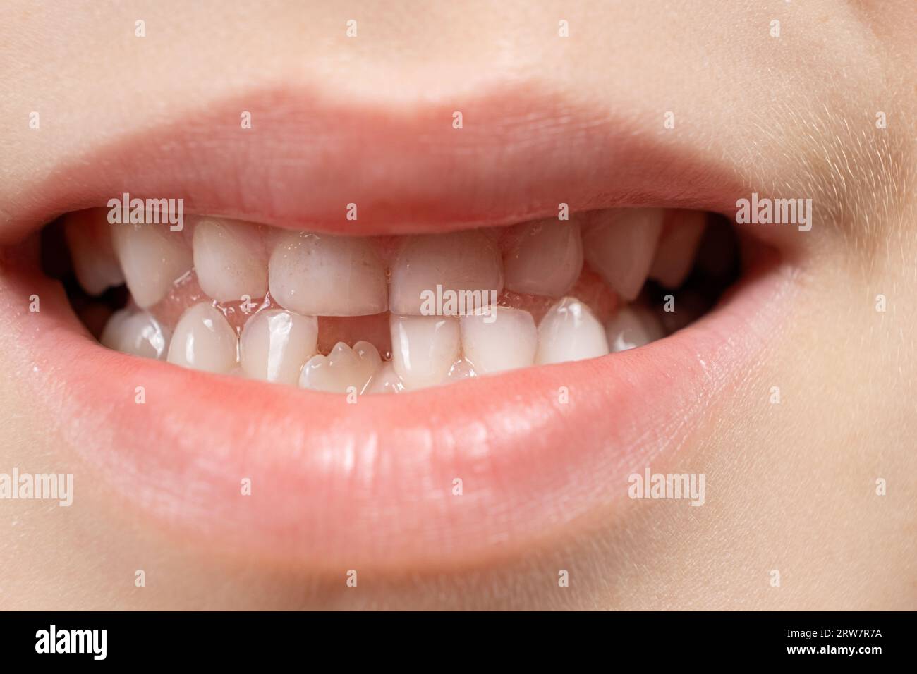 The teeth of a six-year-old child, a crookedly growing incisor in place ...