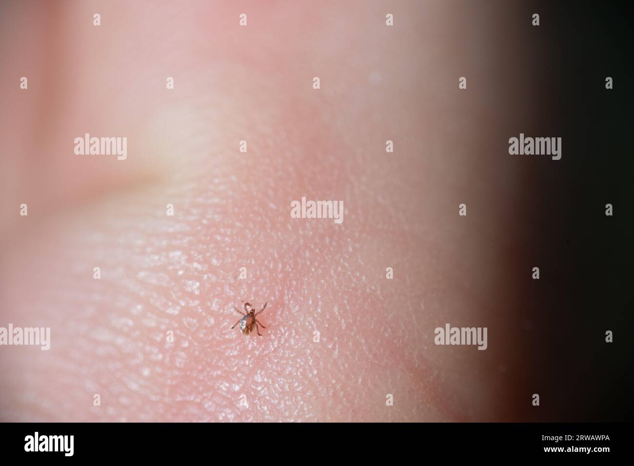 Tick nymph walking on human skin (Ixodes), a parasite in the UK that ...