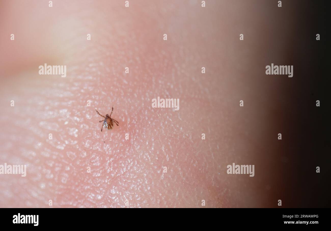 Tick nymph walking on human skin (Ixodes), a parasite in the UK that ...