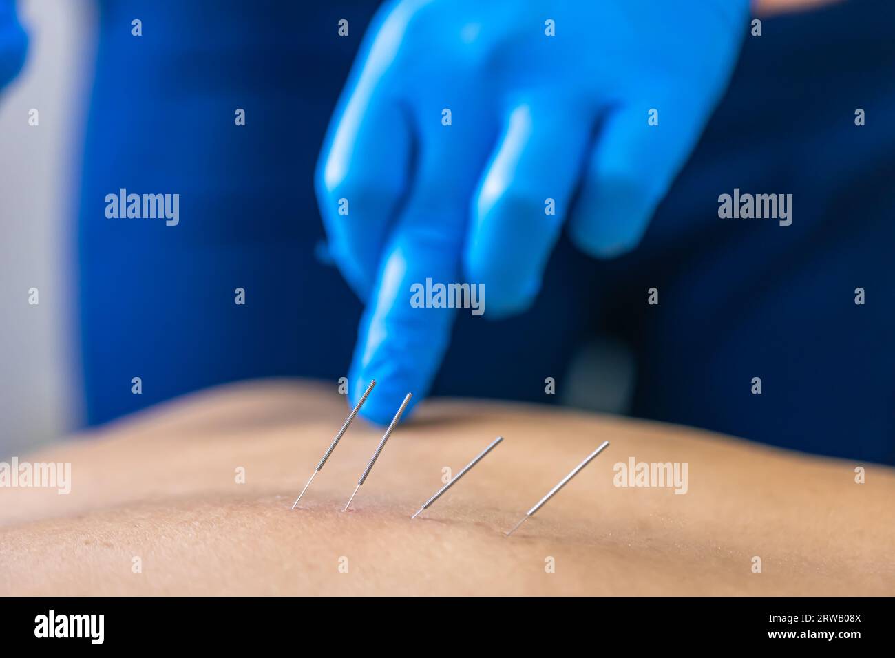 Physio dry needling hi-res stock photography and images - Alamy