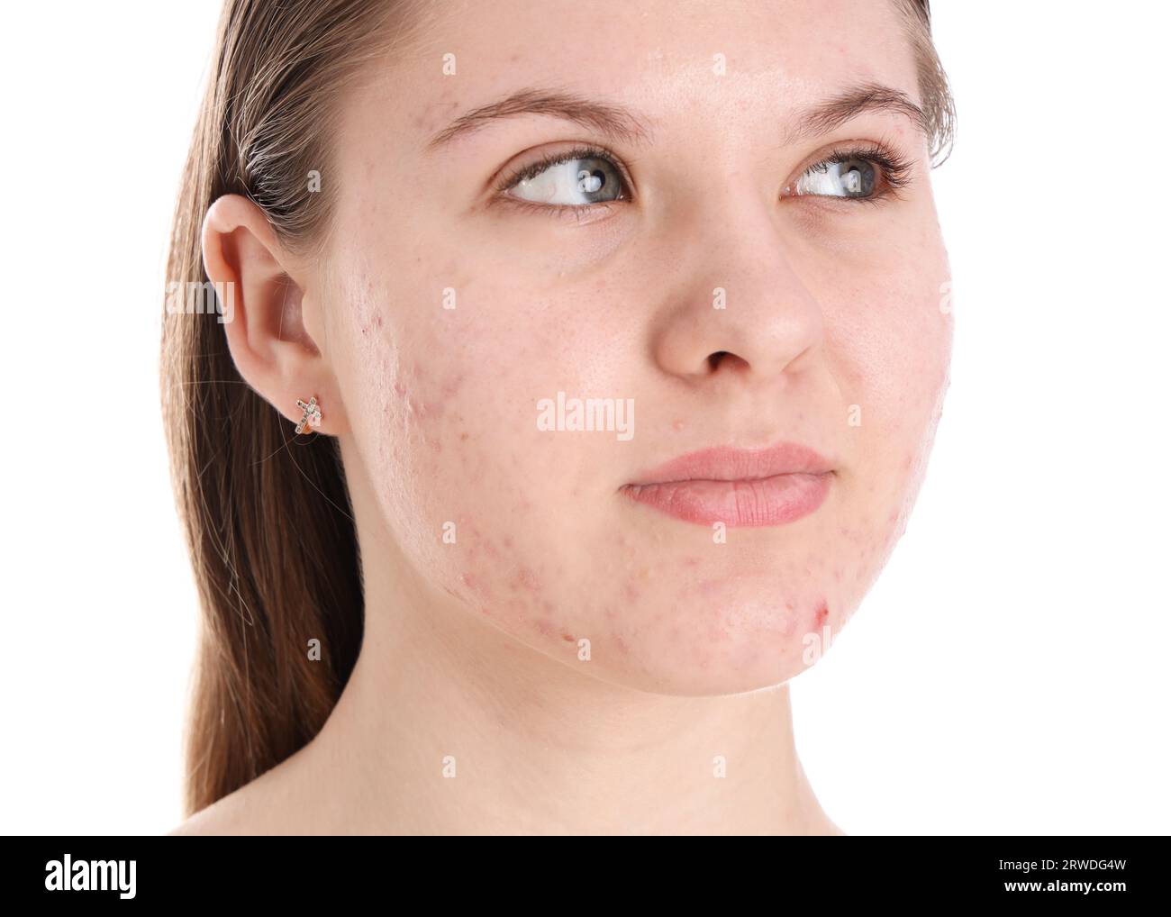 Teenage girl with acne problem on white background, closeup Stock Photo ...