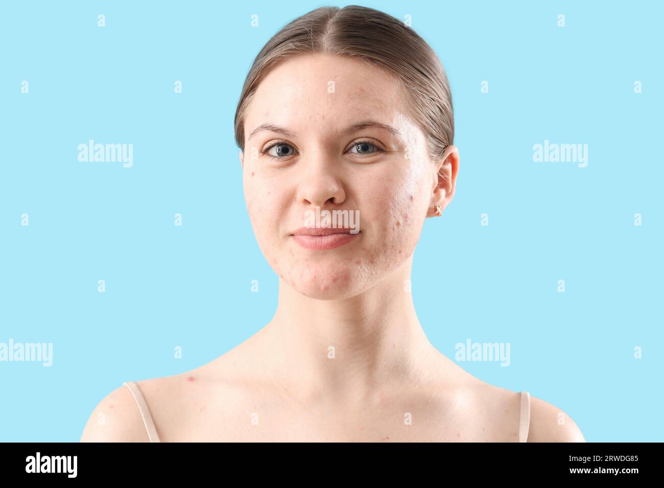 Teenage girl with acne problem on blue background, closeup Stock Photo ...